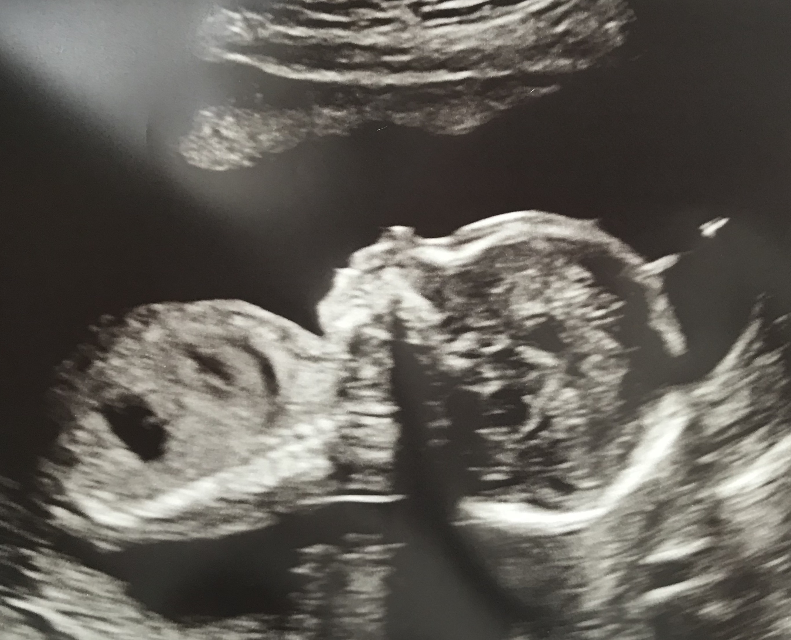 Poetry Friday: The Ultrasound | Reflections on the Teche